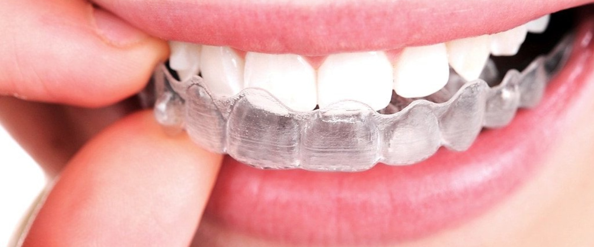 Can I Use Whitening Toothpaste with Invisalign Clear Braces?