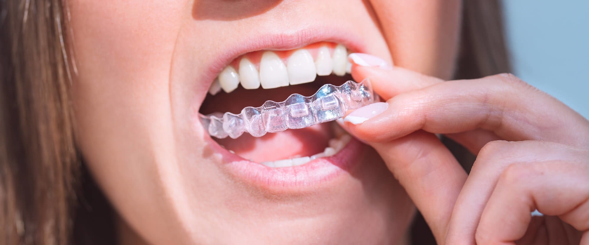 Relieving Discomfort from Invisalign Clear Braces with Dental Wax