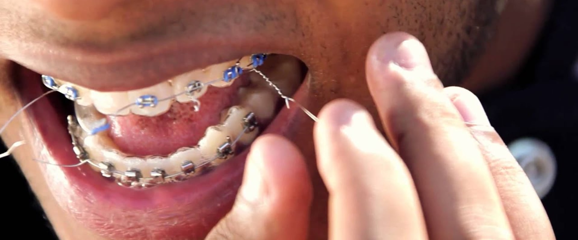 What to Do When Your Invisalign Braces Wire or Bracket Becomes Loose